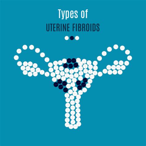 Types Of Uterine Fibroids Things You Need To Know About Them Medfin