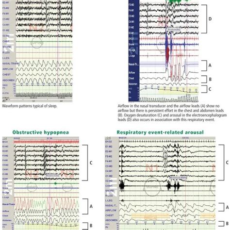 Polysomnogram Excerpts With Normal Sleep Obstructive Apnea