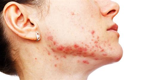 È Promettente Una Nuova Terapia Topica Settimanale Contro Lacne