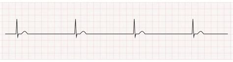 Ekg Monitor Showing Junctional Bradycardia 20203435 Vector Art At Vecteezy