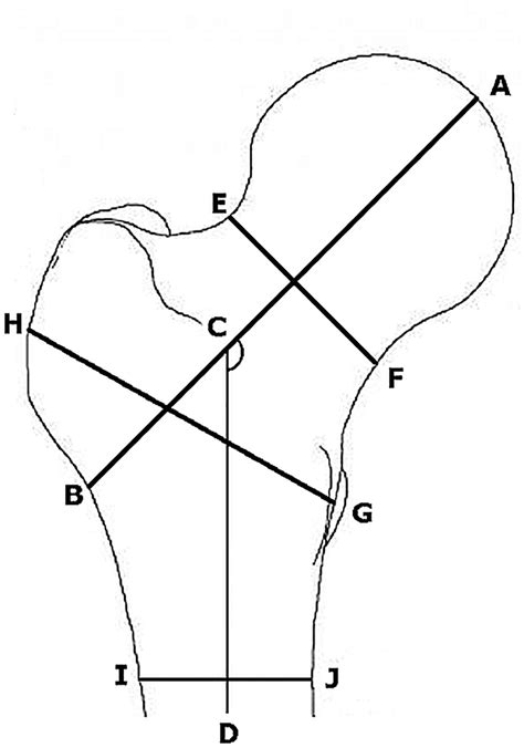Measurement Of The Femur Geometric Parameters Structural Traits Ab Is