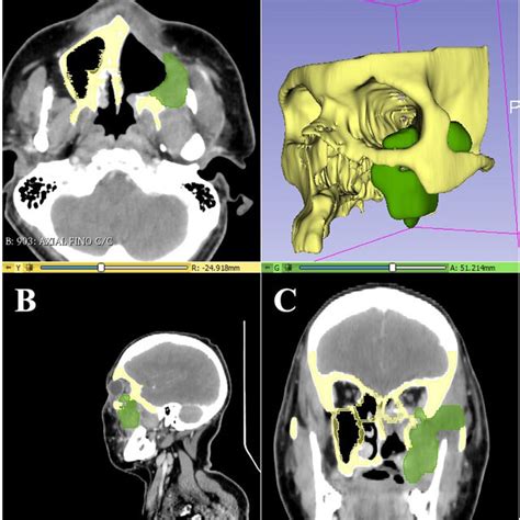 A D Ct Images A Axial Plane Reconstruction B Sagittal Plane