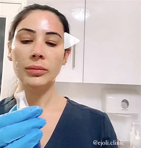 Eiman Demonstrates Microneedling Ejoli Blog East Riding Yorkshire