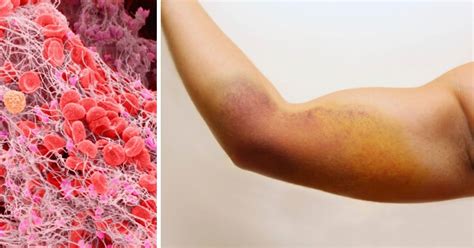 Cómo Saber Si Tengo Un Coágulo Salud180