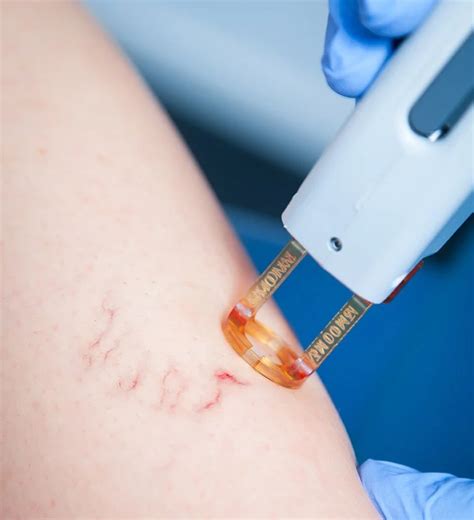 Vascular Laser Treatments Brisbane — Your Dermatologist Brisbane