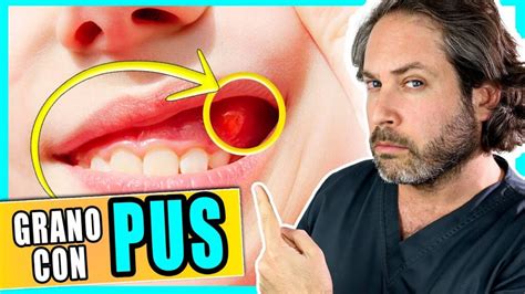 Pus En Las Encías Descubre Las Causas Y Soluciones ※