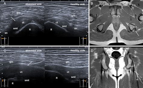 Ultrasound Features Of The Proximal Hamstring Muscle‐tendon‐bone Unit