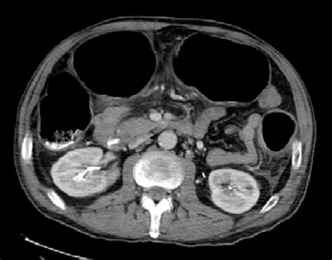 A Cross Sectional View Of A Computed Tomography Scan Of The Abdomen And Download Scientific