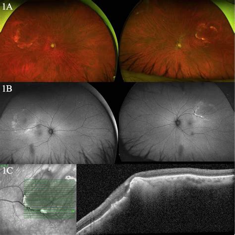 Bilateral Sclerochoroidal Calcifications Canadian Retina Society