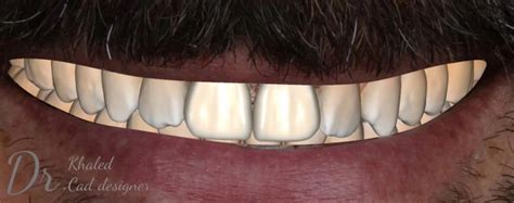 Exocad Dentaldesign Veneers Smiledesign Digitaldentistry Dentalaesthetics Exocaddesigner