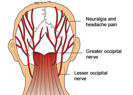 Occipital Neuralgia Pain Locations