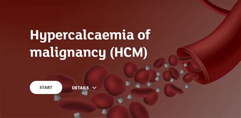 Hypercalcaemia Of Malignancy Hcm Eviq Education