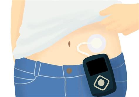 Tandem Diabetes Cares Tslim X2 Insulin Pump Is The First Automated