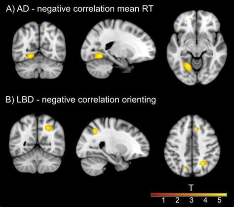 Significant Clusters From Vbm Analysis A Negative Correlation