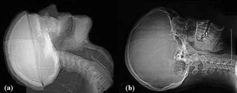 Topogram Of The Phantom On CT A Phantom B Human Download Scientific Diagram