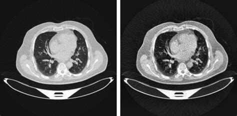 Developing A Deep Learning Model To Classify Cancerous And Non Cancerous Lung Nodules Springerlink