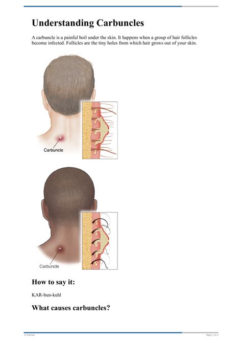 Text Understanding Carbuncles HealthClips Online