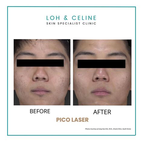 Everything To Know About The Pico Laser Treatment Xncuc