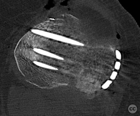 Schatzker 6 Tibial Plateau With Lateral Femoral Epicondyle Osteotomy