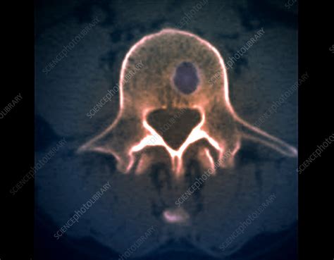 Schmorl S Node Ct Scan Stock Image C055 2644 Science Photo Library