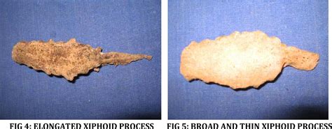 Bifid Xiphoid Process Semantic Scholar