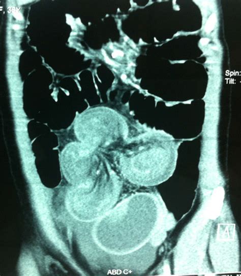 Abdominal Ct Scan Frontal Slice Showing The Intussusception And The Download Scientific
