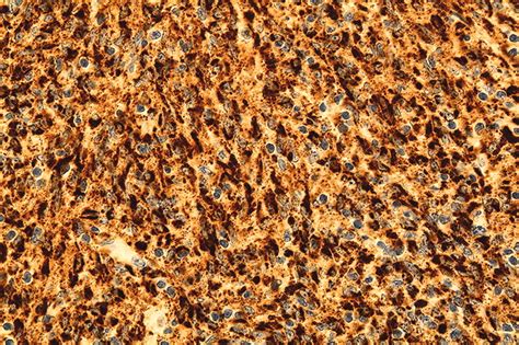 Cutaneous Mycobacterial Spindle Cell Pseudotumour Bmj Case Reports