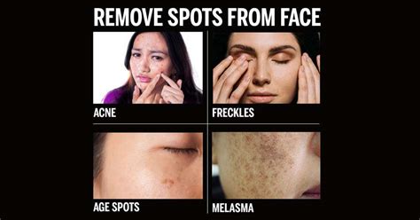 How To Remove Spots From Face Femina In