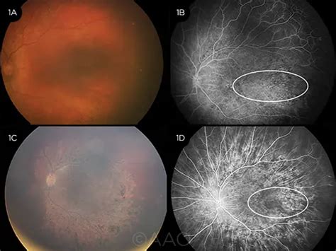 Intravitreal Bevacizumab Or Laser For Rop 4 Year Outcomes American