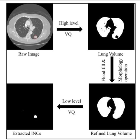 Abbreviations Cade Computer Aided Detection Ct Computed Tomography
