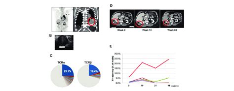 Presence Of Dominant T Cell Clone At Metastatic Site Corresponds With