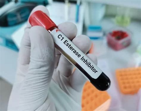 Immune System Diseases Archives Medicaregate