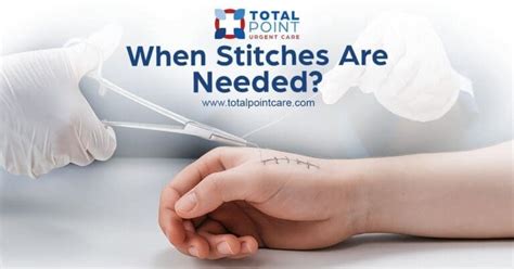 Can Urgent Care Centers Give Stitches Your Guide To Getting Stitches