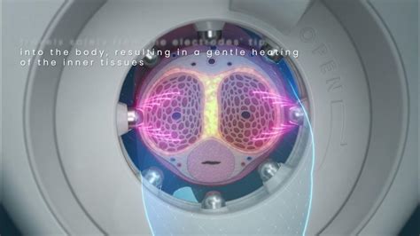 Vertica® Home Use Medical Device To Improve Erectile Dysfunction Ed Youtube