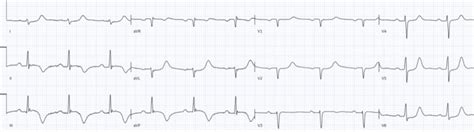 The Ecg In The Diagnosis Of Aortic Dissection Ecg Cases Em Cases
