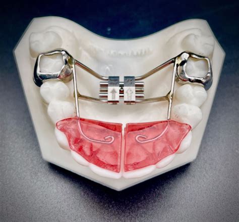 Hyrax Leone Rpe W Anterior Bite Plate Clear Fusion
