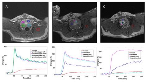 Diffusion And Dynamic Contrast Enhanced Mri For Evaluation Of Prostate Response To 90yttrium