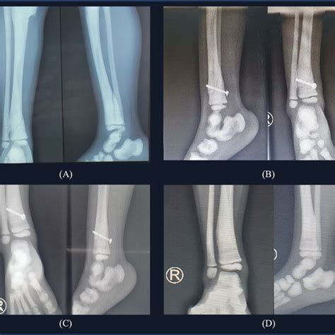 X Ray Of The Right Distal Tibia A Pre Operative B 2 Month Download Scientific Diagram