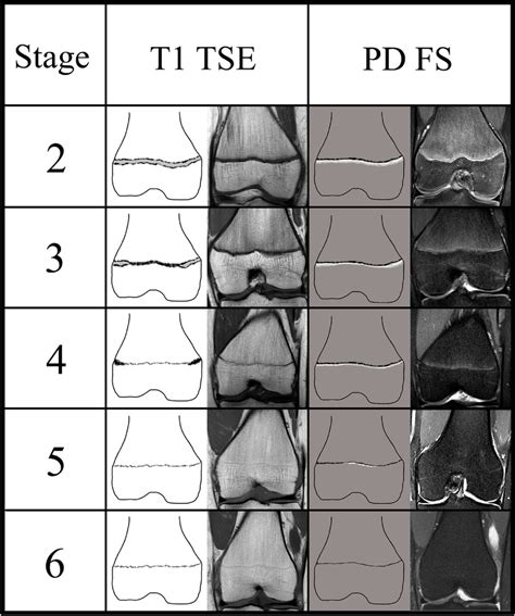 The Classification System By Vieth Et Al [14] Applied To The Dfe Download Scientific Diagram