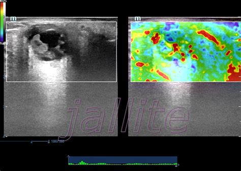 Carcinoma Vs Quiste Dermoide Parótidas