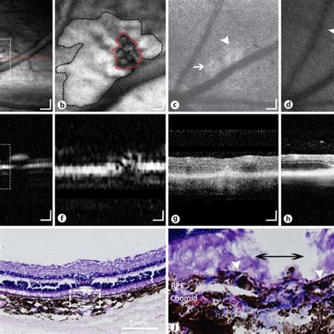 Multimodal Imaging Of Laser Induced Choroidal Neovascularization Cnv Download Scientific