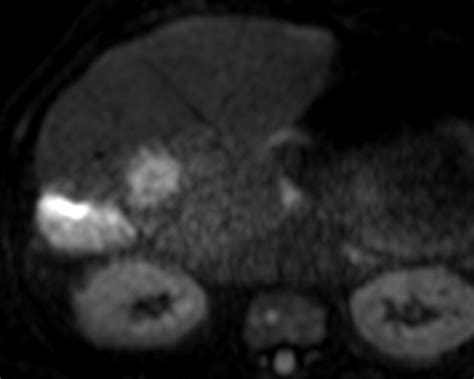 Liver Atlas Diagnosis Metastasis Cholangiocarcinoma