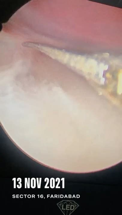 Hysteroscopic Polypectomy Uterus Non Hysteroscopy Gynecologist… Dr Divya Kumar