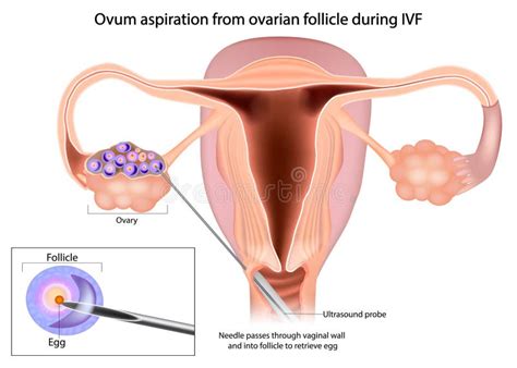 Ultrasound Guided Transvaginal Aspiration Of Ovarian Follicles To