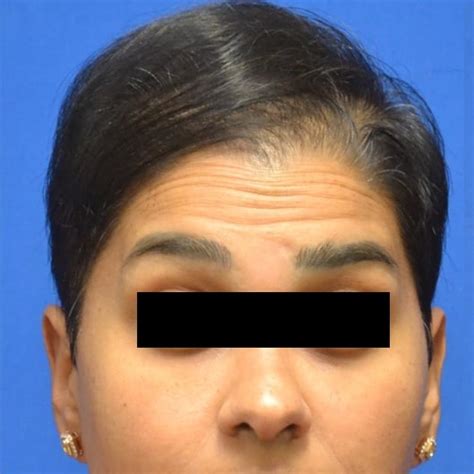 Daxxify Gallery Georgia Plastic And Reconstructive Surgery