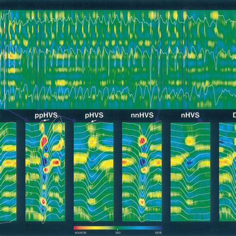 Voltage Versus Depth Profiles Superimposed Onto Csd Maps Of H Vss And