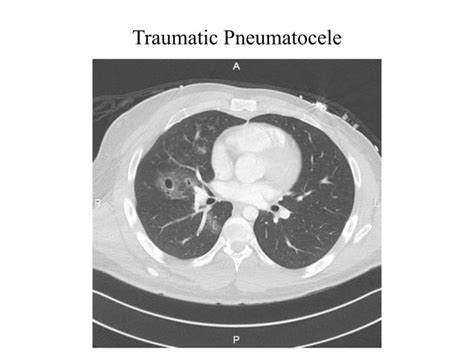 Differential Diagnosis Of Pulmonary Cyst 1 Bullous Emphysema 2