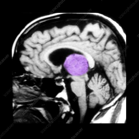 Astrocytoma MRI Stock Image C Science Photo Library