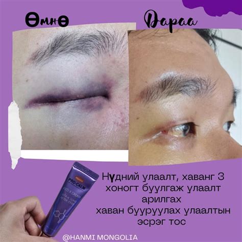 Мон хатан төв Улайлт хөхрөлт арилгах тос нь ирлээ Нүүрний мэс