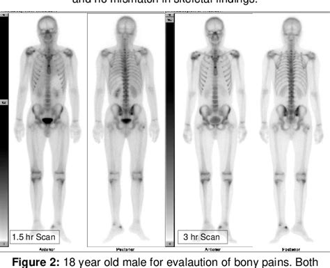 Nuclear Medicine Bone Scan
